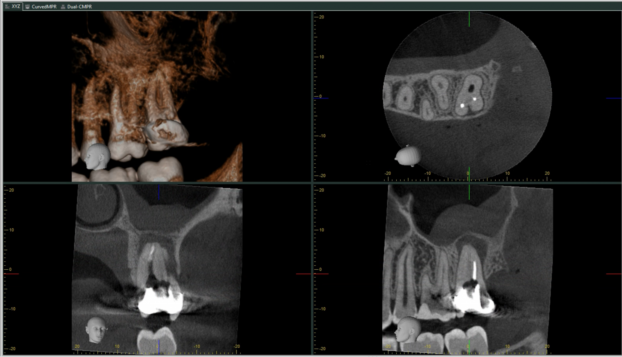 Cbct Assisted Root Canal Treatment Endomontreal