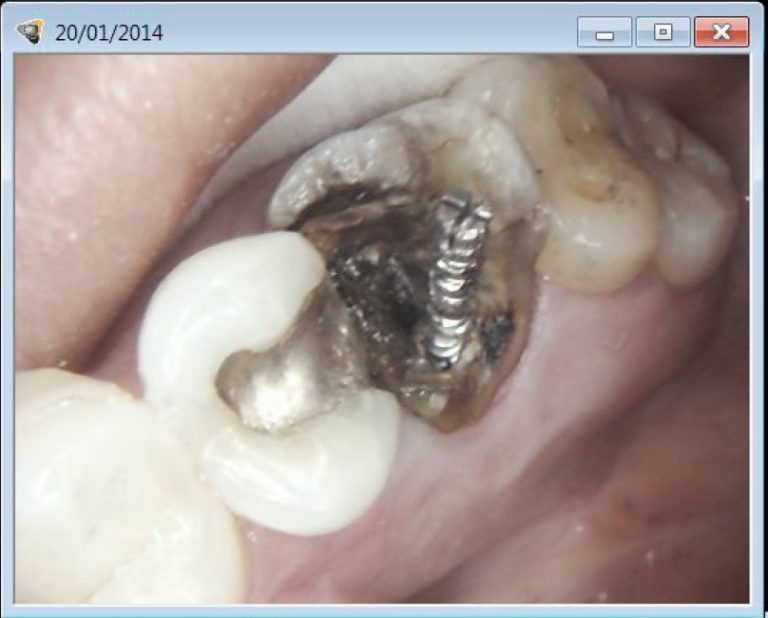 A Post Removal And A Root Canal Therapy Revision To Save A Tooth A 6 Years Follow Up Endomontreal